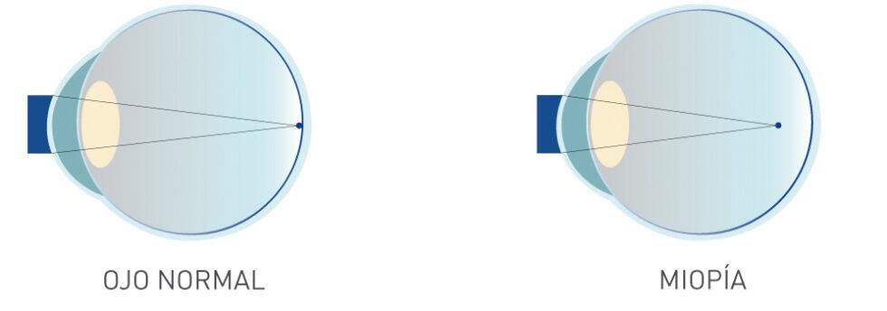 El ojo como instrumento óptico: los defectos de refracción que se ...